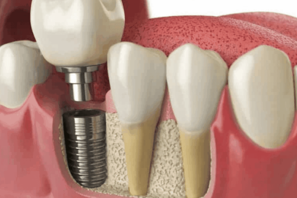 Need Bone Grafting for Implants? | Caps and Crown Dental